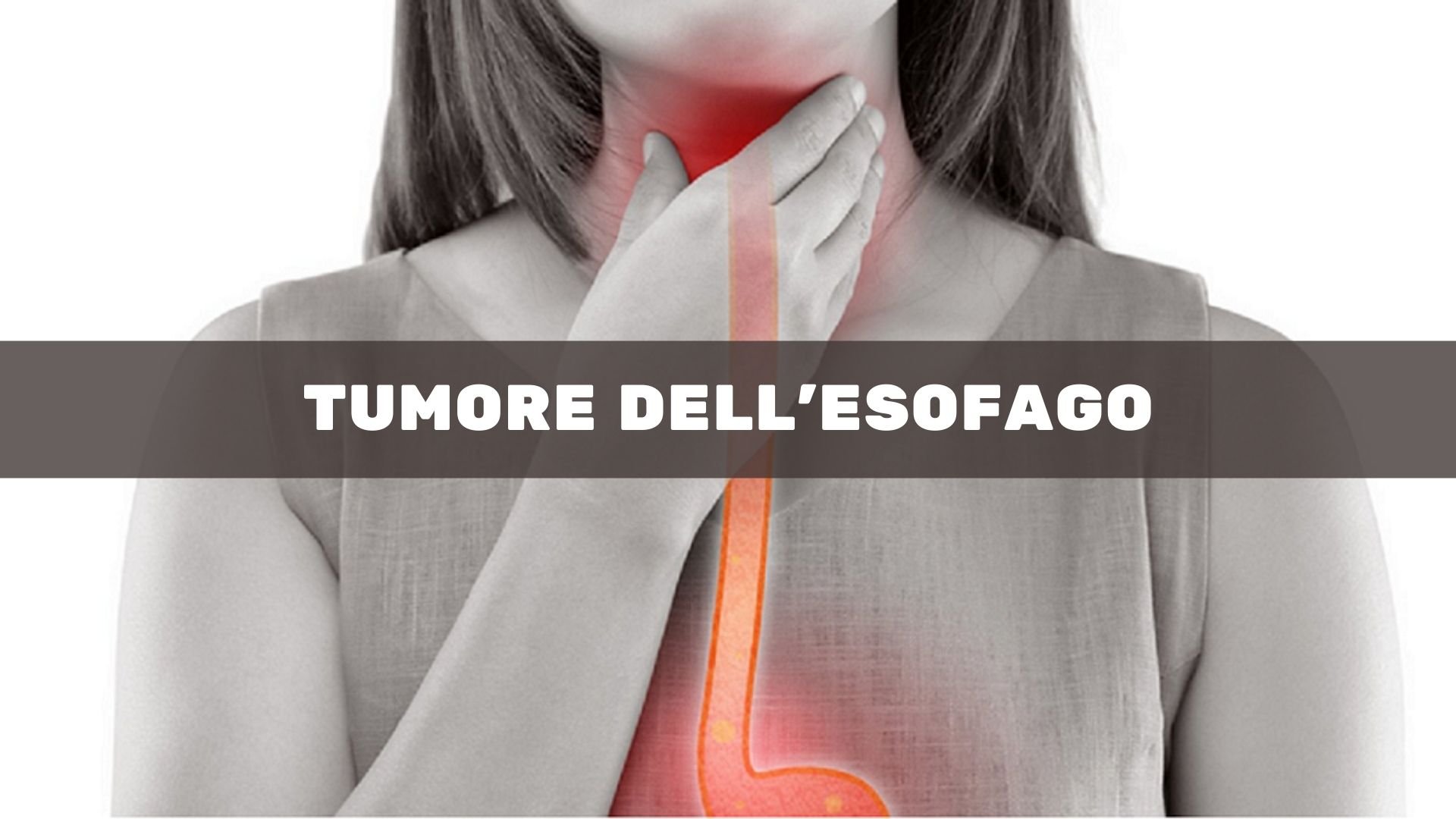 Tumore esofago: guida, sintomi, terapia e assistenza